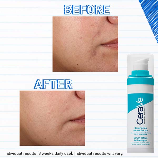 Blemishes 101: Clear It Up Like A Derm | CeraVe